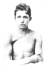 Poland Syndrome, Poland Anomaly, Poland Sequence, Poland's Syndrome ...